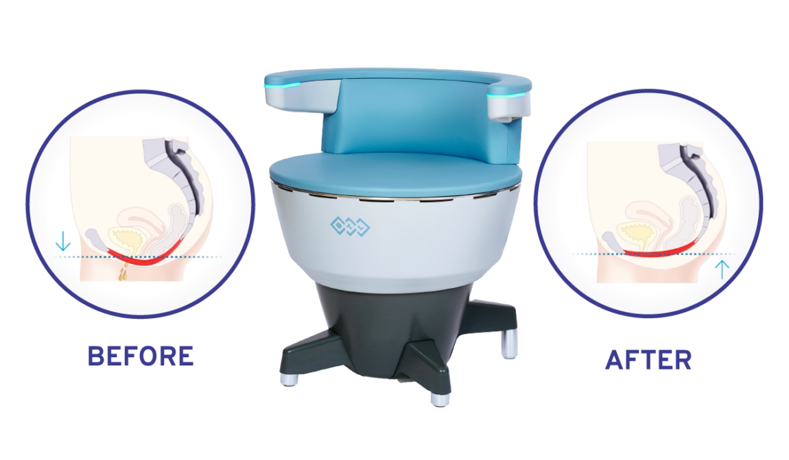 EmSella Pelvic Floor Therapy Joplin MO - Advanced Practice Wellness Clinic